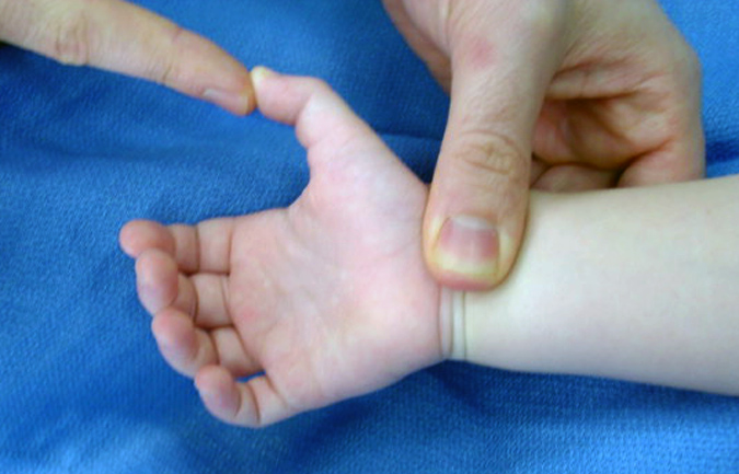 TRIGGER THUMB PEDIATRIC | Hand Surgery Resource